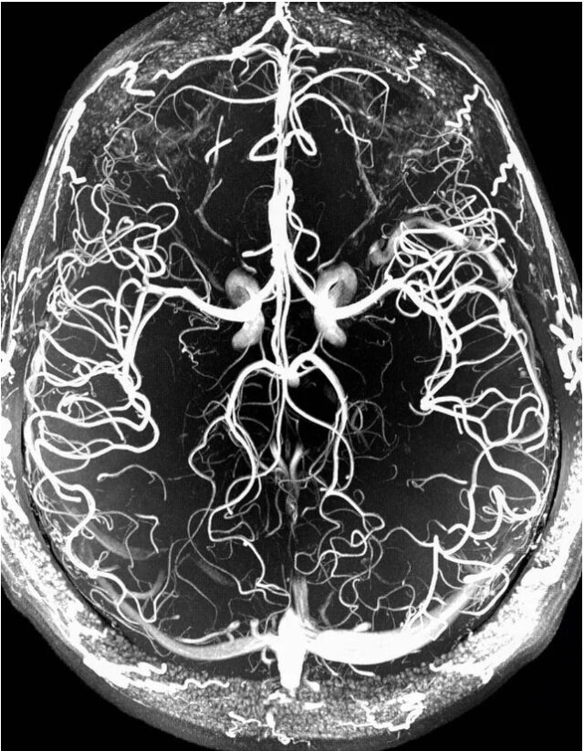 MRA (magnetic resonance angiography) - Kansas Imaging Consultants